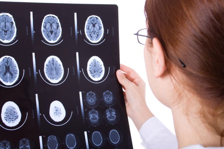 Traumatic Brain Injury (TBI): Symptoms, Causes & Legal Options | Jacoby ...
